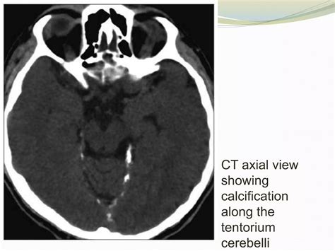 Physiological And Pathological Calcification Of Brain Pptx