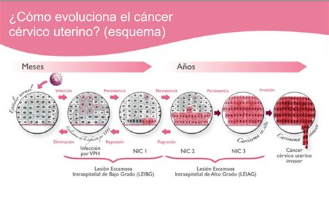 Cáncer De Cérvix Y Vph
