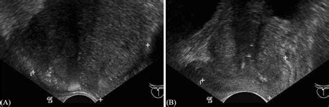 Prostatic Ultrasound Radcare Health