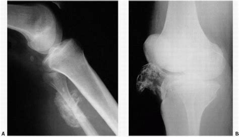 Skeletal And Extraskeletal Calcification And Ossification Syndromes Basicmedical Key