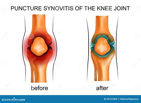 Synovitis Of A Knee Frontal And Side View Of Human Knee Joint Cartoon Vector Cartoondealer