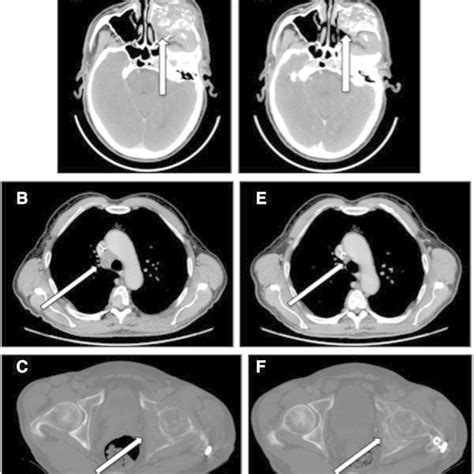 Comparison Of CT Scans Realized Before And After Two Months Of Download Scientific Diagram