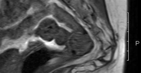 Coccygeal Mri Album On Imgur
