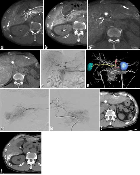 Effective Utilization Of Conventional Transarterial Chemoembolization And Drug Eluting Bead