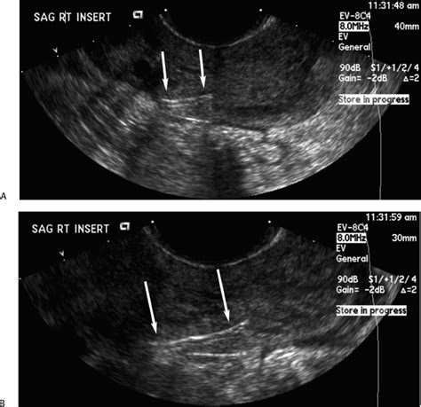 Essure Ultrasound