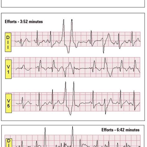 Isolated Ventricular Ectopy And Coupled Induced During Cardiopulmonary Download Scientific