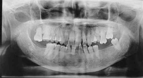 Orthopantomograph Shows Anatomic Variation On Right Side Of Condyle