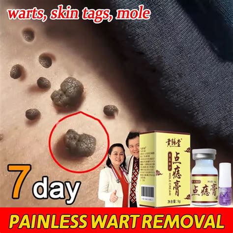 Genital Warts Permanent Cure Health Nigeria