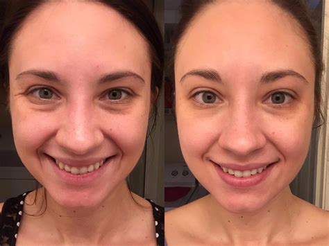 Vitamin C On Face Before And After Detroit Chinatown