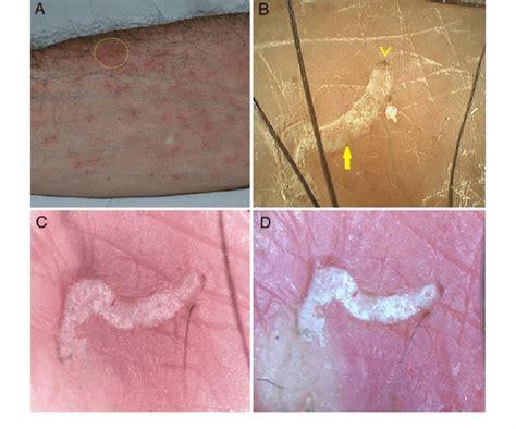 Sarcoptes Scabiei Burrow