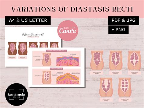 Diastasis Recti Variations Diagram Abdominal Muscles Separation Linea Alba Pdf  Png
