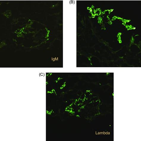 Follow Up Graph Of Proteinuria In The Patient From Diagnosis Until Week