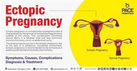 Ectopic Pregnancy Birth