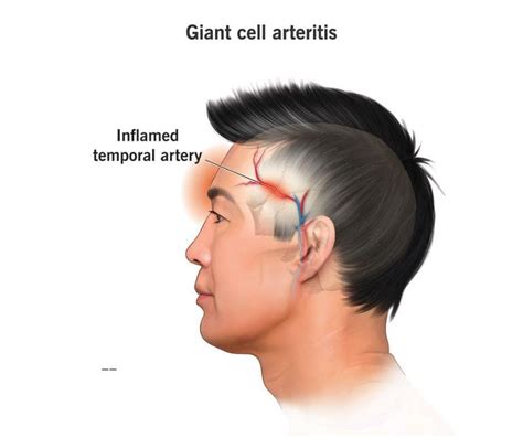 Oral Temporal Arteritis Also Known As Giant Cell Arteritis Gca Is A Condition