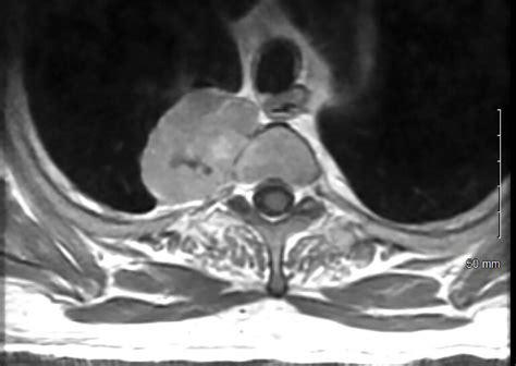 Axial Thoracic Spine Mri With Gadolinium Contrast Image Of A Partially Download Scientific