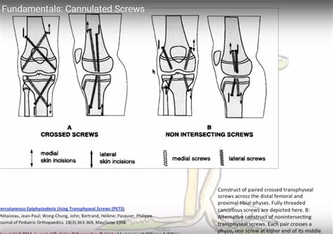 Epiphysiodesis Using Cannulated Screws —