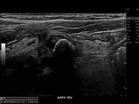Appendicolith Ultrasound