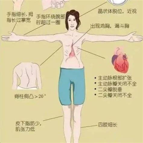 【科普】罕见病科普系列三：马凡综合征——看电视剧《关于唐医生的一切》有感患者遗传性心然