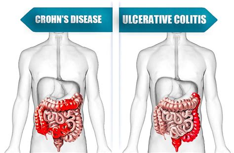 Ulcerative Colitis And Crohns Disease What Are The Differences Healthella