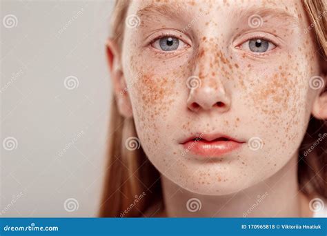 Inclusive Beauty Girl With Freckles Standing Isolated On Grey Looking