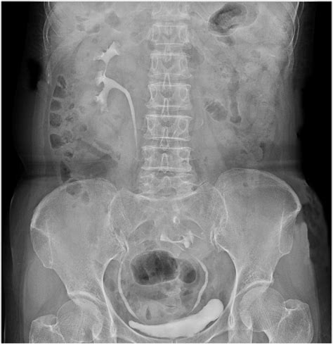 Postoperative Intravenous Pyelogram Download Scientific Diagram