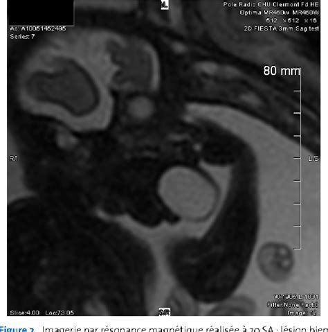 Figure 2 From [congenital Mucocele Of The Ventral Face Of The Tongue] Semantic Scholar