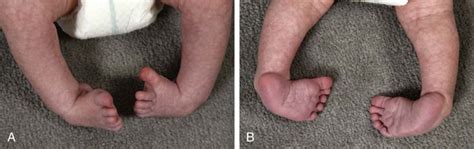 Congenital Foot Deformities Musculoskeletal Key