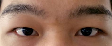 의사에게 물어보세요 남자 눈매교정 고민 강남언니 1등 성형수술and피부시술 정보앱