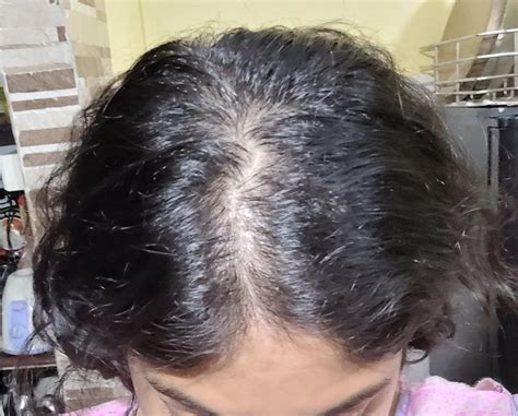 Telogen Effluvium Shedding Rtelogeneffluvium