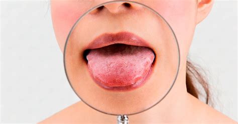 La Lengua Enfermedades Curiosidades Y Recomendaciones
