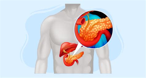 Beyond The Bile Advanced Insights Into Primary Sclerosing Cholangitis Medtigo Courses