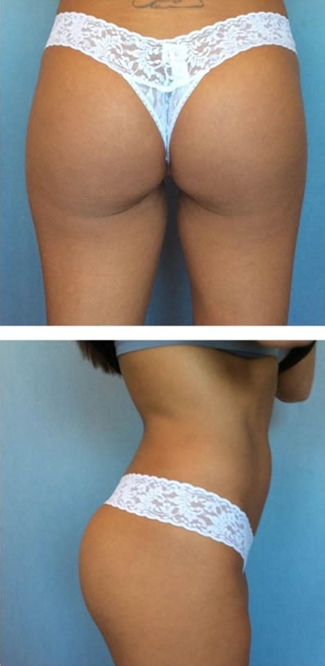 Buttock Augmentation Multimedica Plastic Surgery Medical Tourism