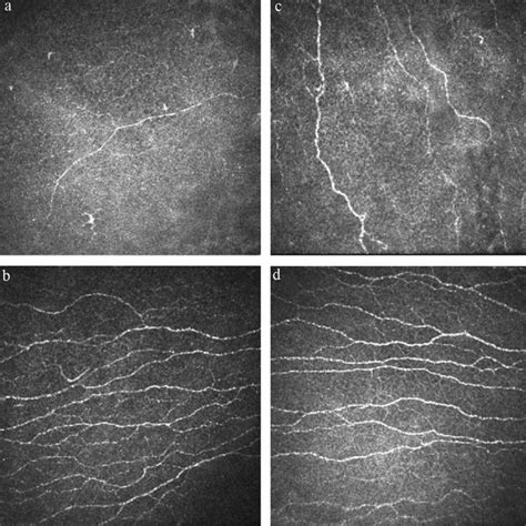 Corneal Confocal Microscopy Images Showing A Reduction In The Sub Basal