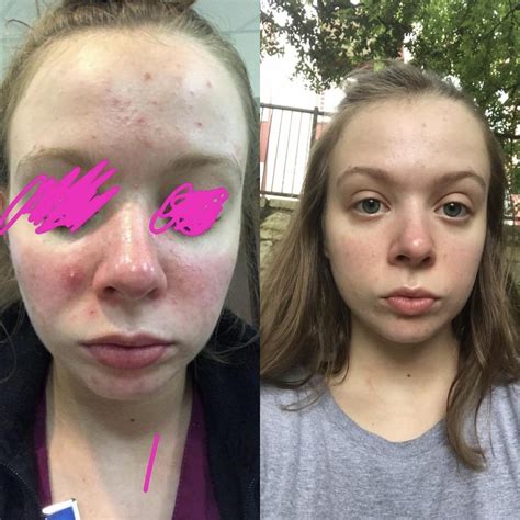 I Finally Saw A Dermatologist And This Happened Doxycycline
