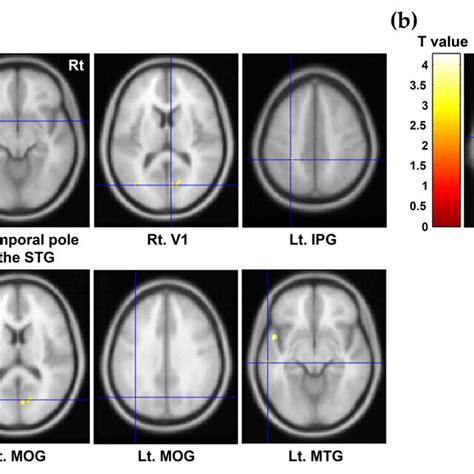 Results Of Voxel Based Partial Correlation Analysis Between The Raw