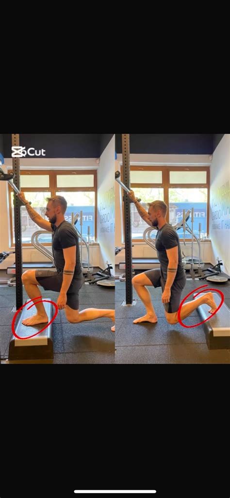 Ffess Vs Rfess Ffess Pelvis More Posterior Orientation Rfess