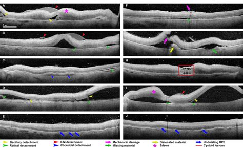 Ex Vivo Oct Based Multimodal Imaging Of Human Donor Eyes For Research Into Age Related Macular
