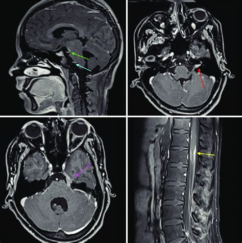 T1 Post Contrast Images Green And Blue Arrows Show 3rd And 6th Cranial Download Scientific