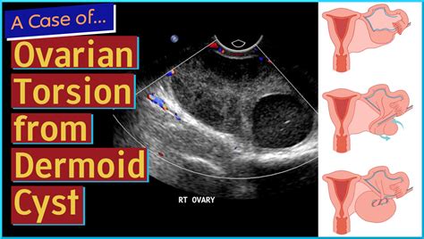 Ovarian Torsion From A Dermoid Cyst Meded Cases