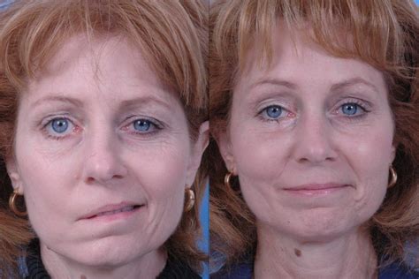 Parálisis Facial De Bell Camara Hiperbarica En Valencia España
