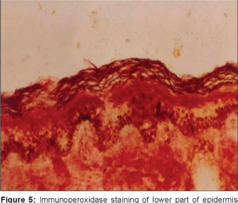 Figure 2 From Pemphigus Vegetans An Unusual Presentation Semantic