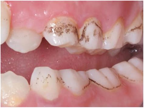 6 وصفات منزلية لعلاج بلاك الأسنان بسهولة مصراوى