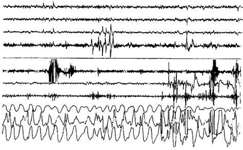 Two Minute Epoch Of Rapid Eye Movement Sleep Note Electro Oculogram