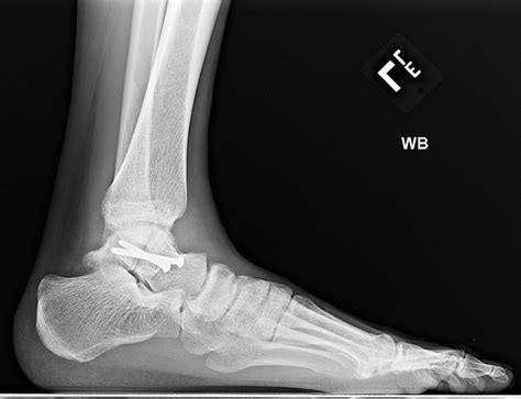 Talus Fracture Symptoms And Causes