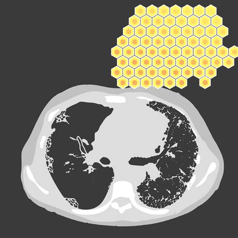 Idiopatic Pulmonary Fibrosis A Simple Approach To A Complex Problem