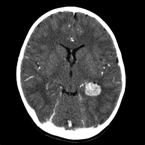 Choroid Plexus Papilloma Cpp Pacs