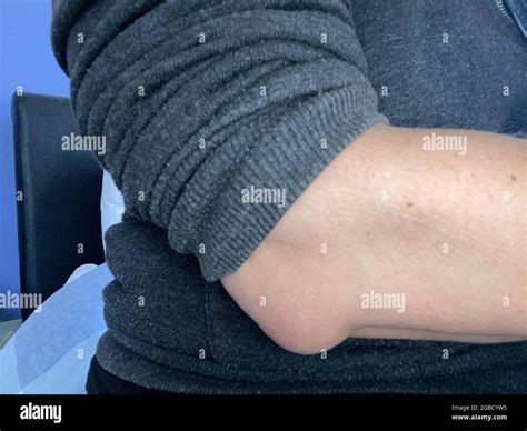 Olecranon Bursitis Wird Manchmal Als „popeye Ellenbogen“ Bezeichnet