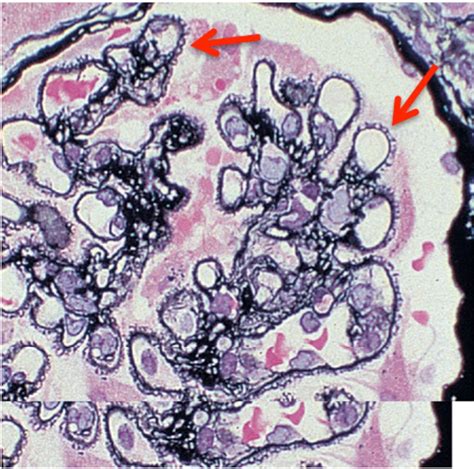 Figure 1 From Primary Membranous Nephropathy Semantic Scholar