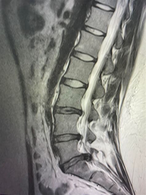 L5 S1 Posterolateral Disc Protrusion R Sciatica