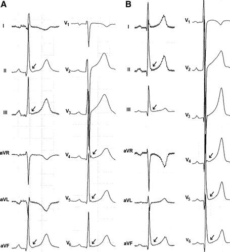 Early Repolarization Circulation
